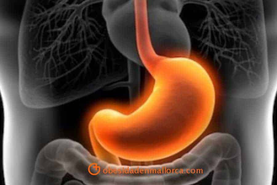 Tengo reflujo ¿Hay alternativas al tratamiento continuo de un protector ...